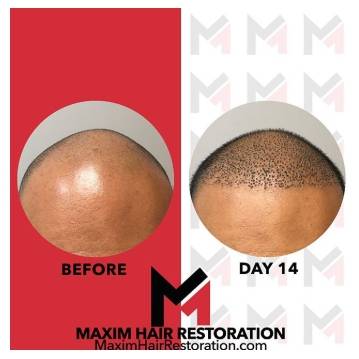 Scalp Microneedling (For Healthy Hair Growth) [Istanbul] | Trambellir