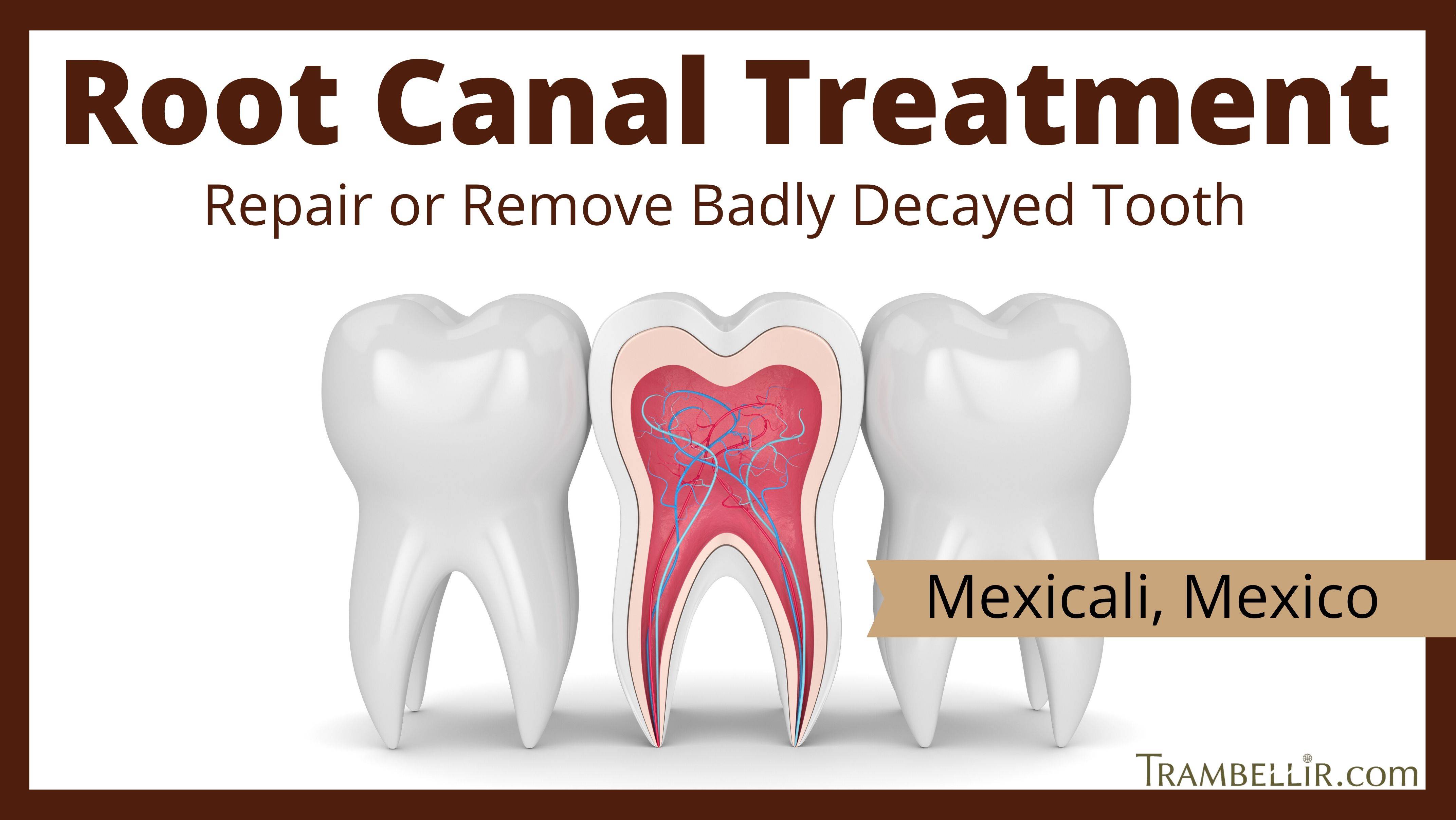 Root Canal Treatment (Repair or Remove Badly Decayed Tooth) | Trambellir