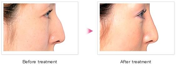 Eagle Nose (Eliminate Protruding Nose) [Tokyo] | Trambellir