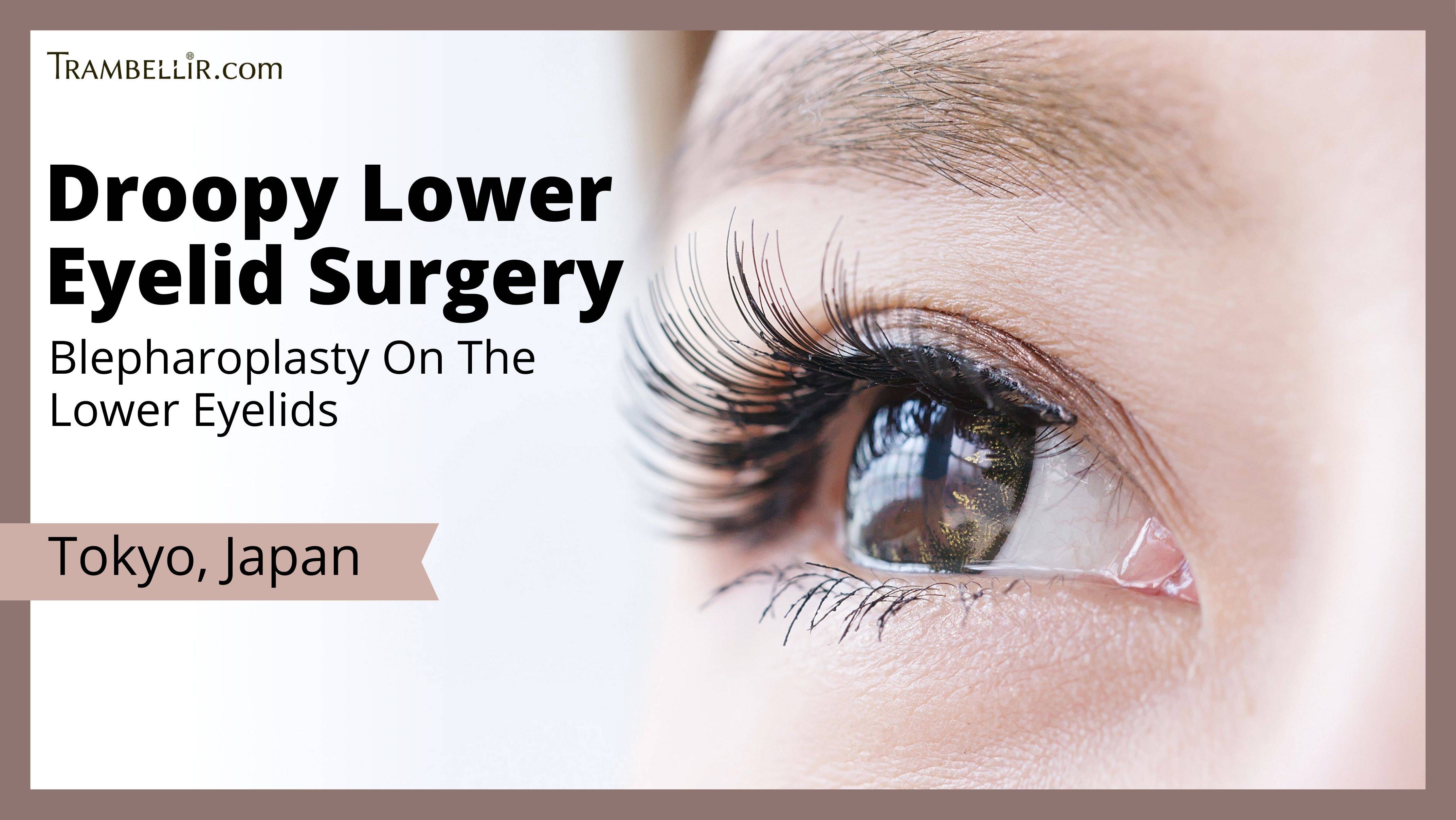 Eyelid Surgery (Anti-aging Eyelid Rejuvenation) | Trambellir
