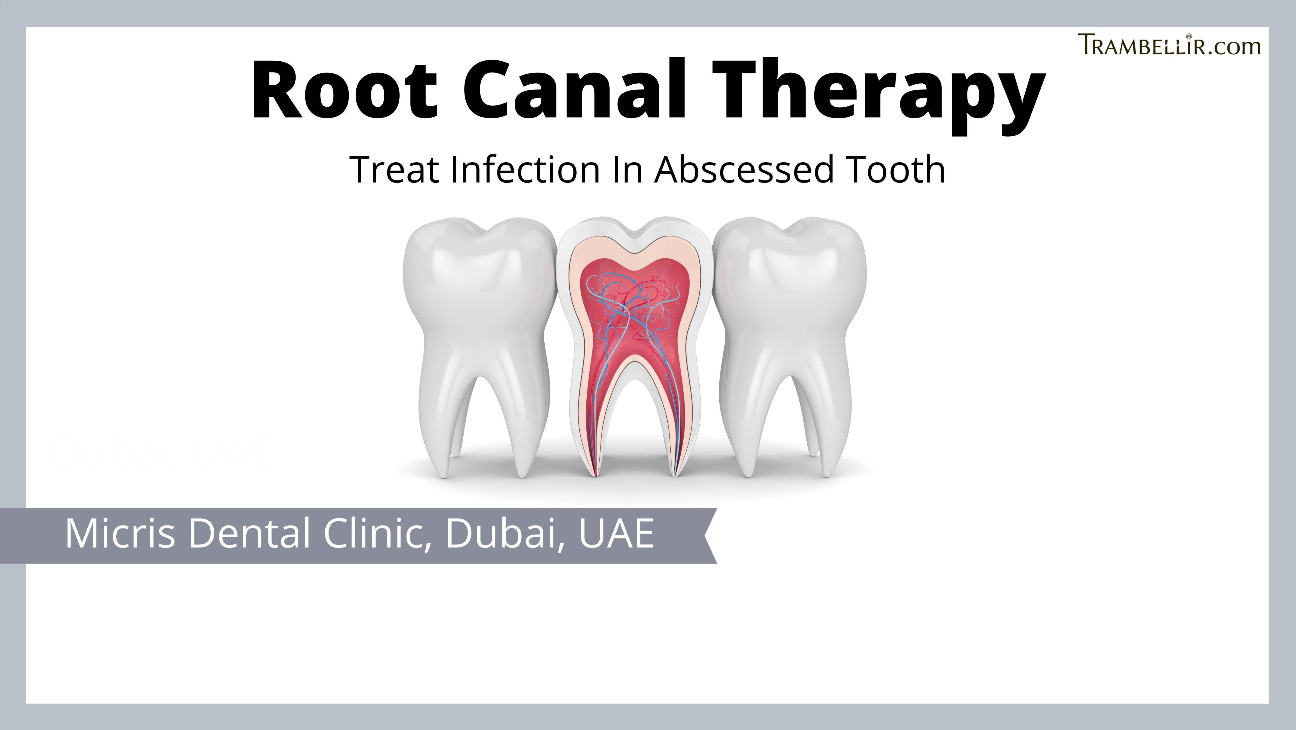 Root Canal Therapy (Treat Infection In Abscessed Tooth) | Trambellir