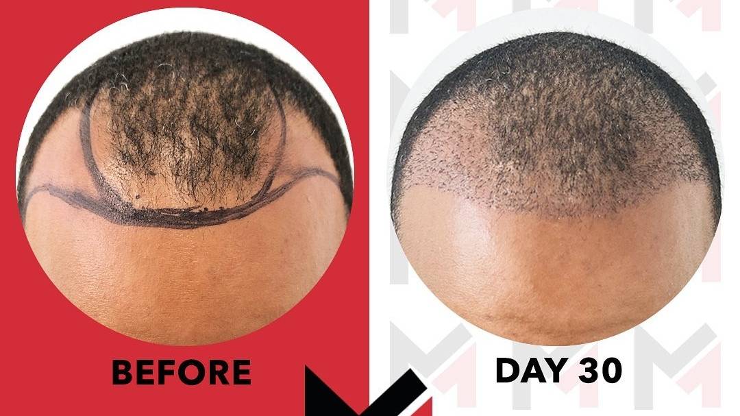 Stem Cell Hair Therapy (Restore Growth of Natural Hair Follicles) [New ...