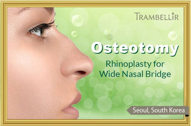 Osteotomy (Rhinoplasty for Wide Nasal Bridge) | Trambellir