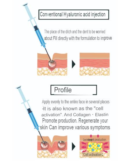Profhilo Injection Improve Skin Elasticity And Hydration Trambellir