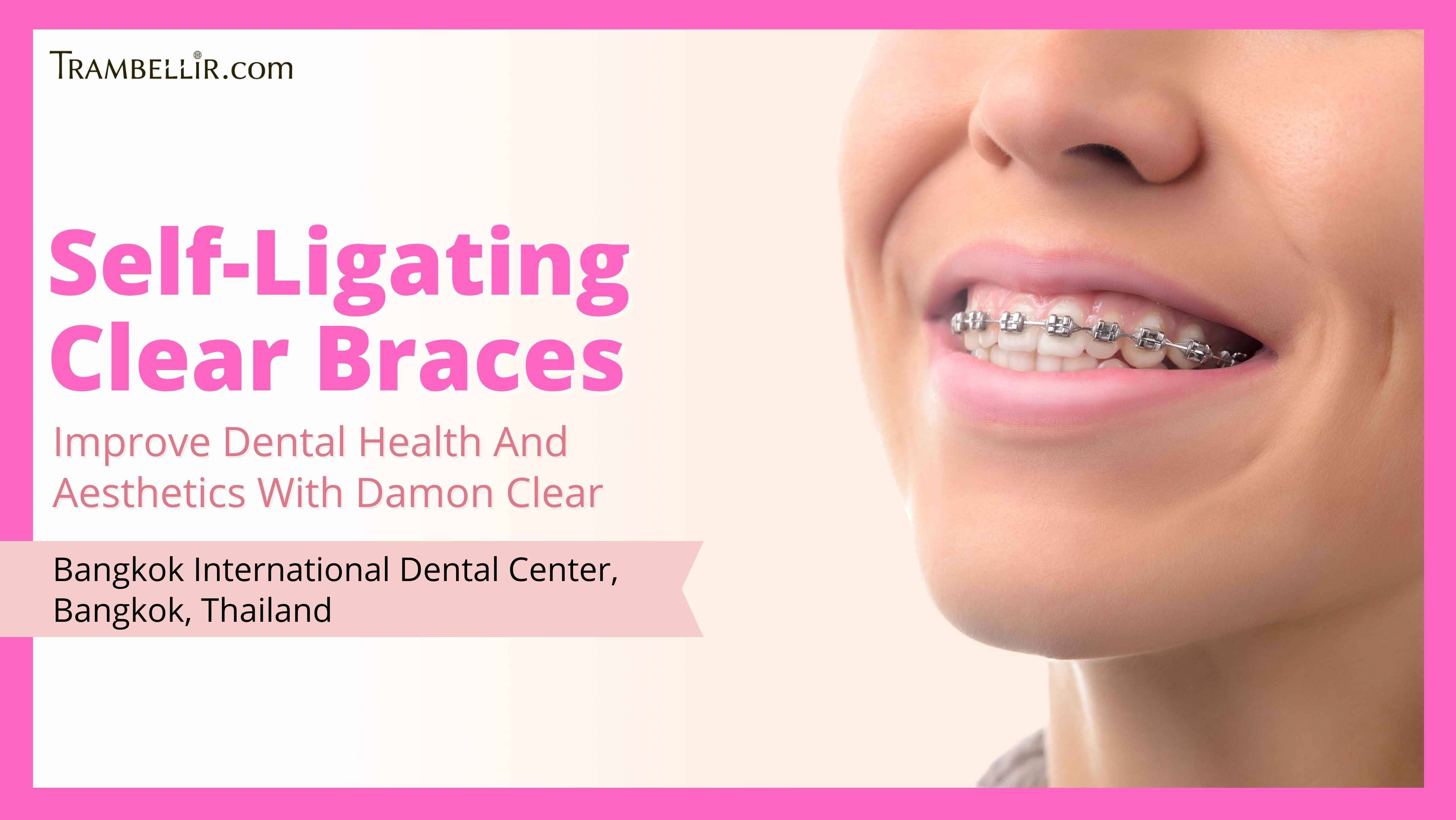 Self-Ligating Clear Braces (Improve Dental Health And Aesthetics With ...